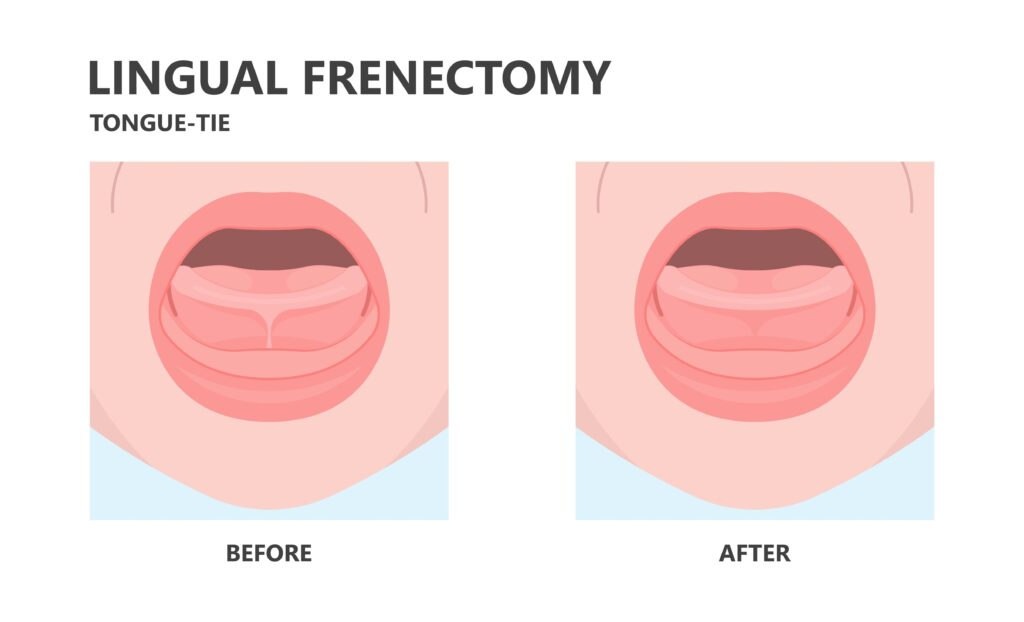 Lingual Frenectomy - Lombardo & Cho Dentistry